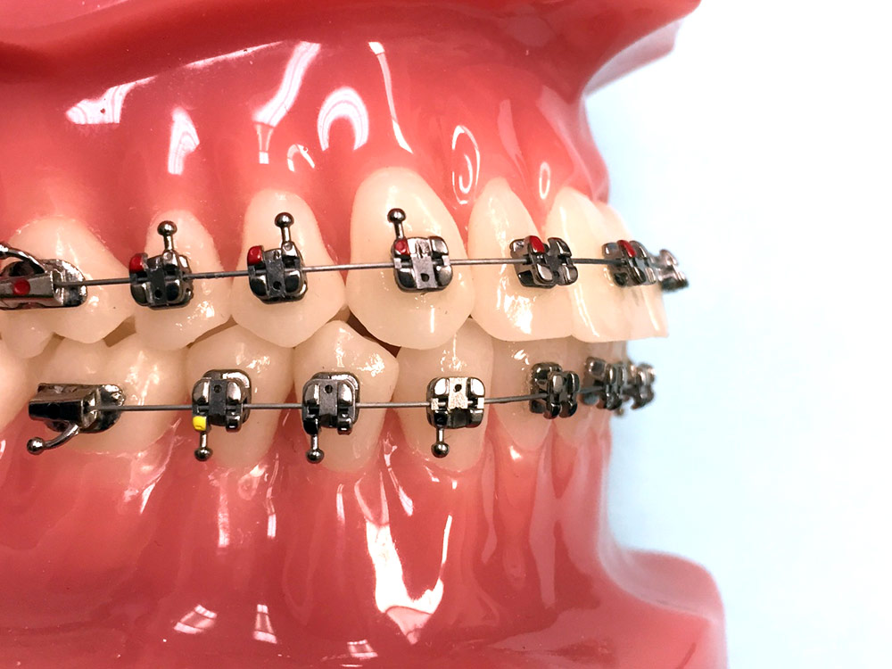 Agility® Self-Ligating Bracket System (9670)