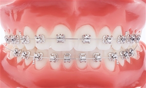 Rhodium Plated Roth .022 Brackets (20 Brackets) (27018)