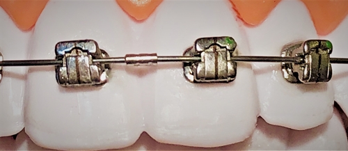 Extreme Torque Bracket System (20 Brackets) (27019)