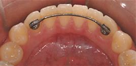 Lingual Flat Twist Retainer Wire - Preformed Bondable (27060)