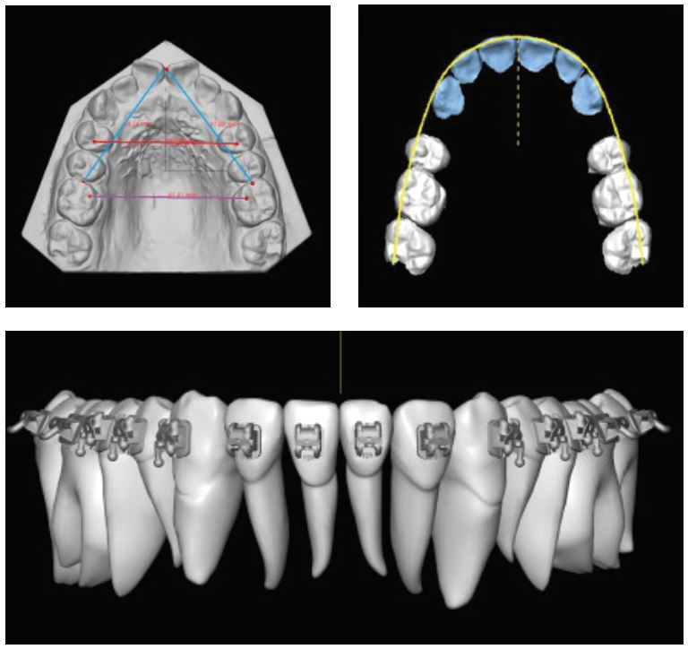 Ortho Insight 3D® Precision Bracket Placement System (22083)