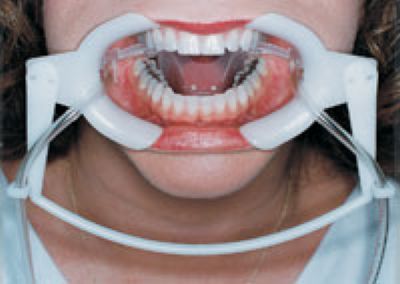 Nola Dry Field Retractors (kit) (30414)