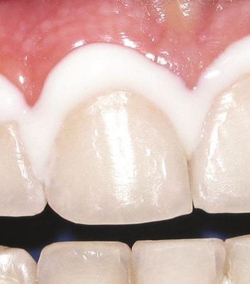 Liquid Dam 3ml syringe - Piece (39318)