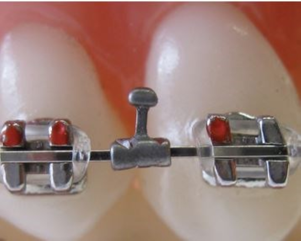 Ortho Specialties Gold Tone Hooks (20 ct) (30281)