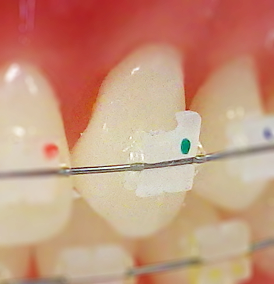 Accent™ Ceramic Brackets, MBT (5 ct) (30293)